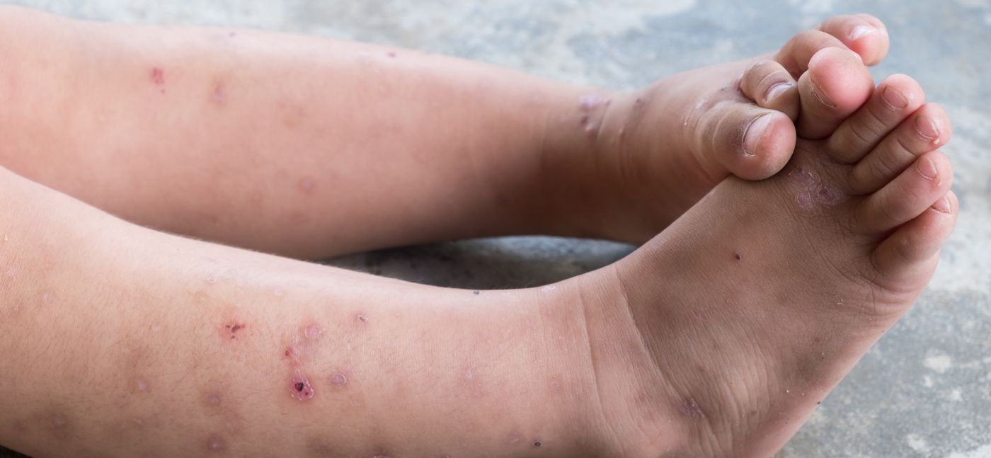 Manifestaciones clínicas de la dermatitis atópica | GalenicumDerma