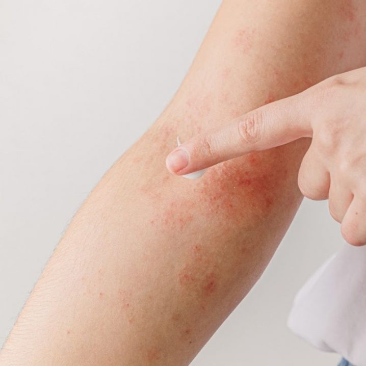 Tratamiento de la dermatitis atópica | GalenicumDerma